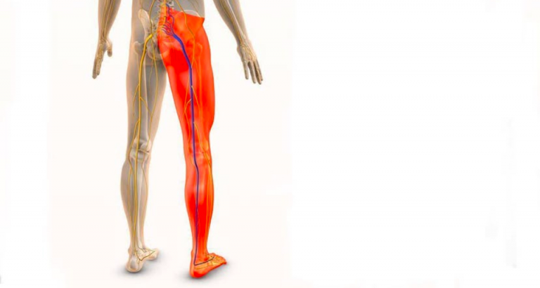Fisioterapia para ayudar con la ciática | Fisiodomus